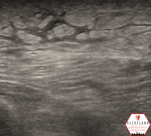Intern Ultrasound of the Month: Cellulitis of the Lower Extremity ...