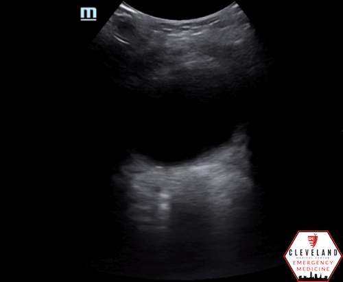 Case Presentation of Imperforate Hymen and the Utilization of Pelvic ...