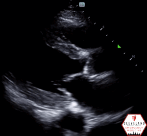 Intern Ultrasound of the Month: Left Ventricular Hypertrophy ...