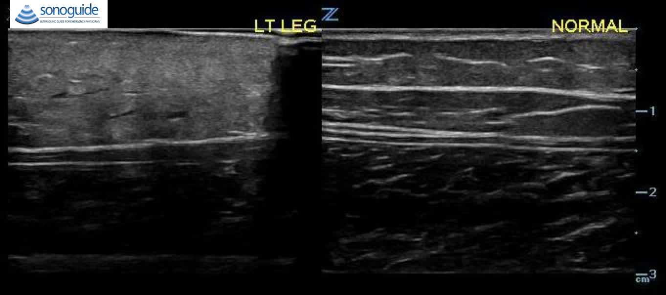 Intern Ultrasound of the Month: To Drain or Not to Drain? Ultrasound ...