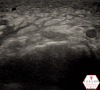 Intern Ultrasound of the Month: Cellulitis of the Lower Extremity ...