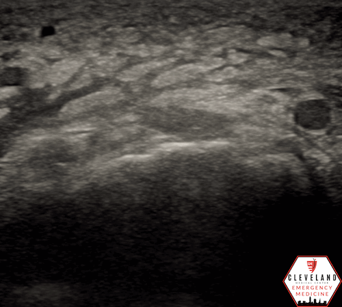 Intern Ultrasound of the Month: Cellulitis of the Lower Extremity ...