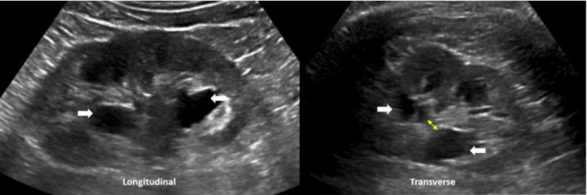 Intern Ultrasound of the Month: Hydronephrosis — University Hospitals ...