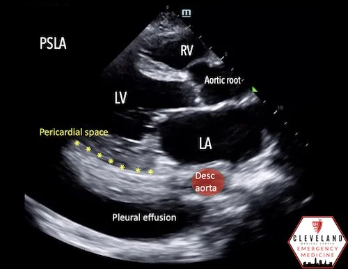 Intern Ultrasound of the Month: Pericardial Effusion and Cardiac ...