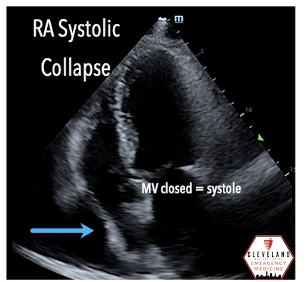 Intern Ultrasound of the Month: Cardiac Tamponade — University ...