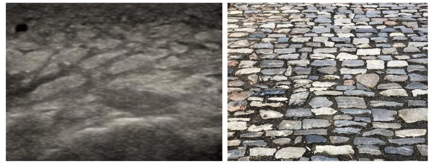 Intern Ultrasound of the Month: Cellulitis of the Lower Extremity ...