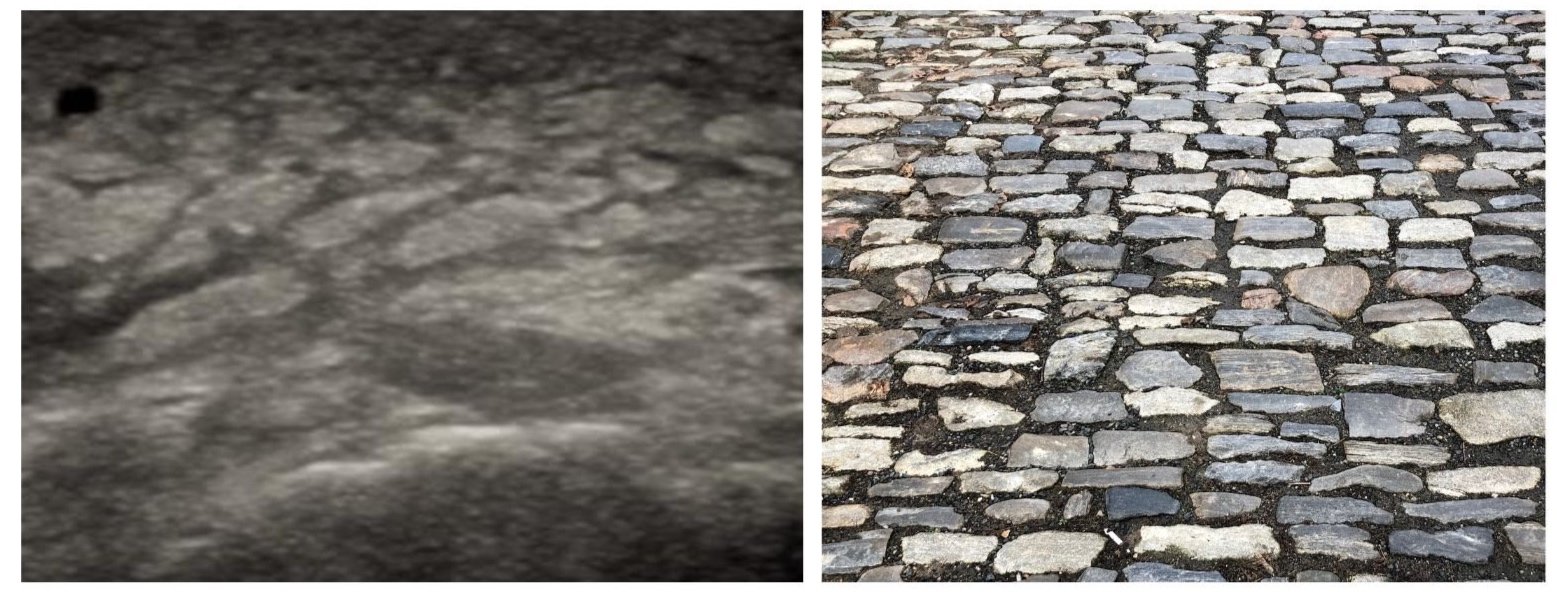 Intern Ultrasound of the Month: Cellulitis of the Lower Extremity ...