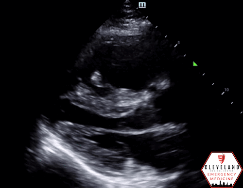 Intern Ultrasound of the Month: Don't Overlook the Right Ventricle ...