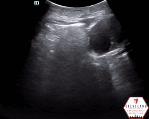 Intern Ultrasound of the Month: AAA — University Hospitals Emergency ...