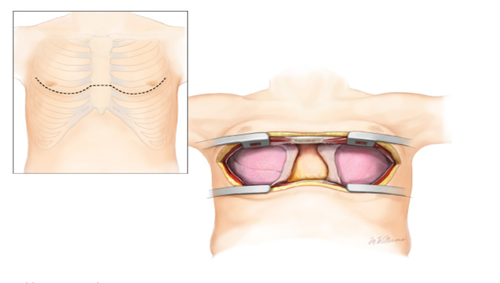 Resuscitative Thoracotomy: When to Crack the Chest — University Hospitals Emergency Medicine ...