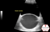 Case Presentation of Imperforate Hymen and the Utilization of Pelvic ...