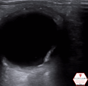 Intern Ultrasound of the Month: Retinal Detachment — University ...