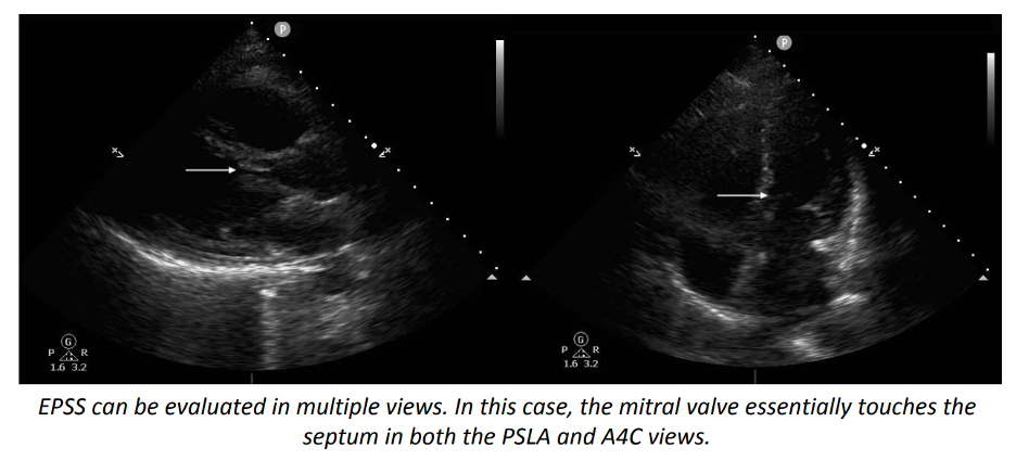 Intern Ultrasound of the Month: Left Ventricular Hypertrophy ...