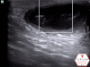 Intern Ultrasound of the Month: To Drain or Not to Drain? Ultrasound ...