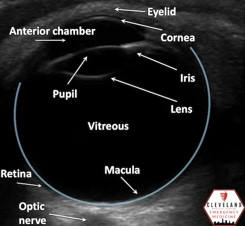 Intern Ultrasound of the Month: Retinal Detachment — University ...