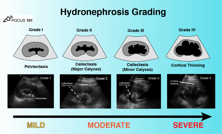 Intern Ultrasound of the Month: A Case of Hydronephrosis Leading to the ...
