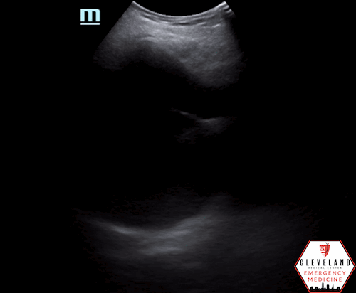 Case Presentation of Imperforate Hymen and the Utilization of Pelvic ...