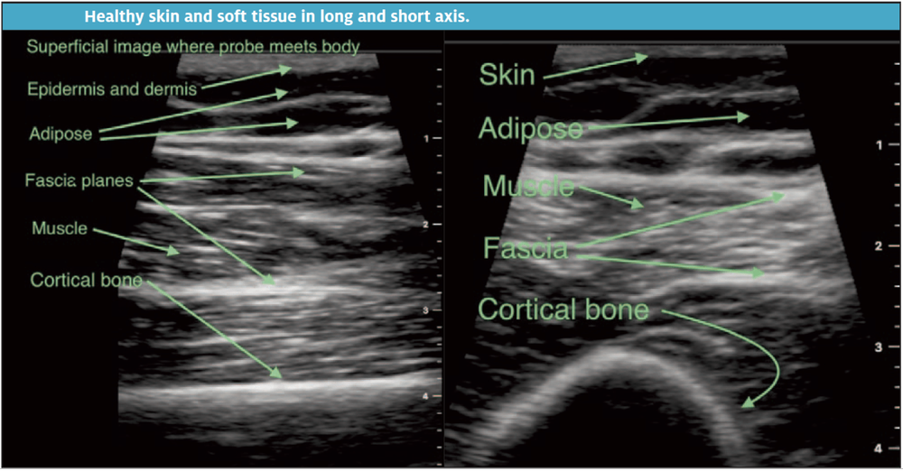 Intern Ultrasound of the Month: Cellulitis of the Lower Extremity ...