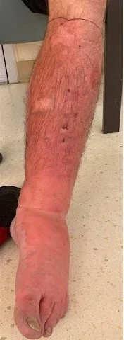 Intern Ultrasound of the Month: Cellulitis of the Lower Extremity ...