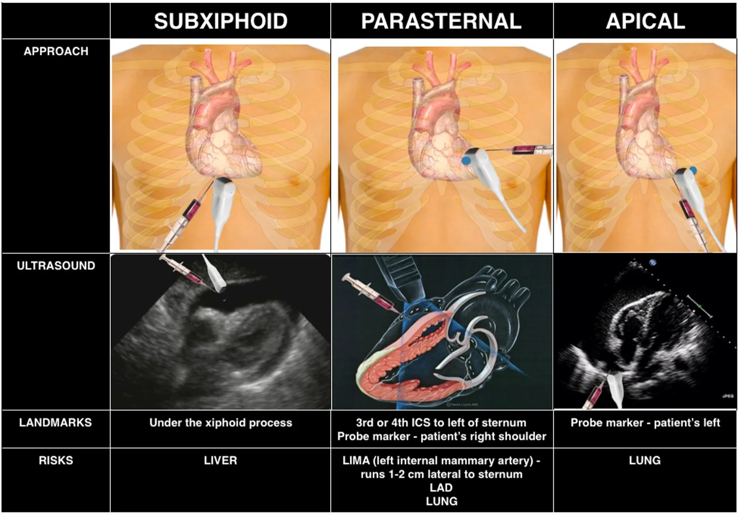 Intern Ultrasound of the Month: Cardiac Tamponade — University ...
