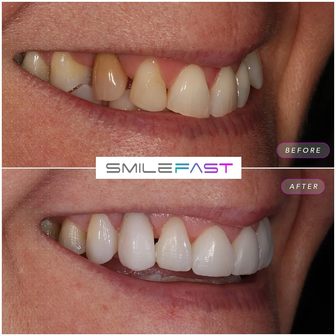 Smilefast® Composite Bonding Treatment Edinburgh | Stockbridge Dental ...