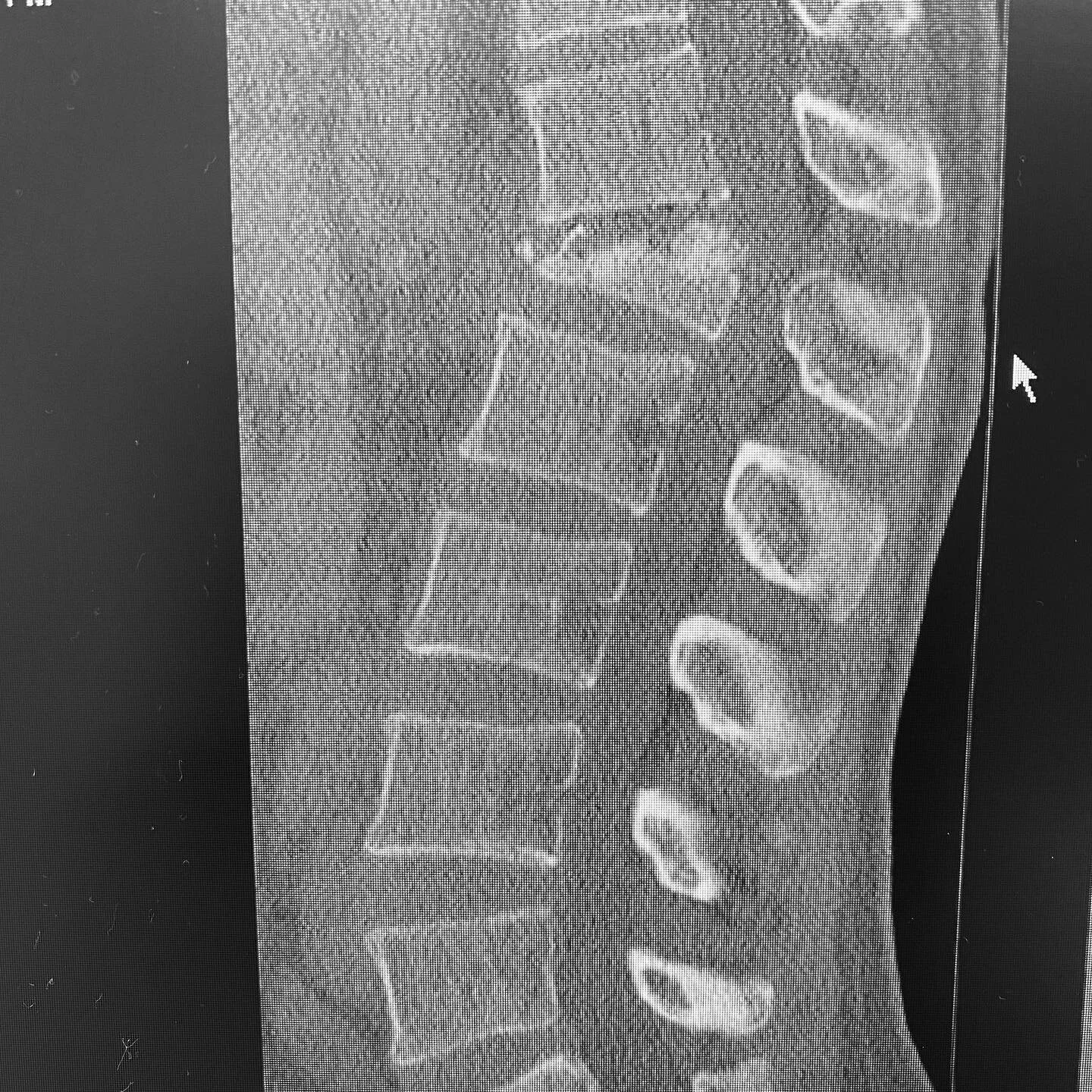 Dr. Chad M. Patton - Spine Surgery