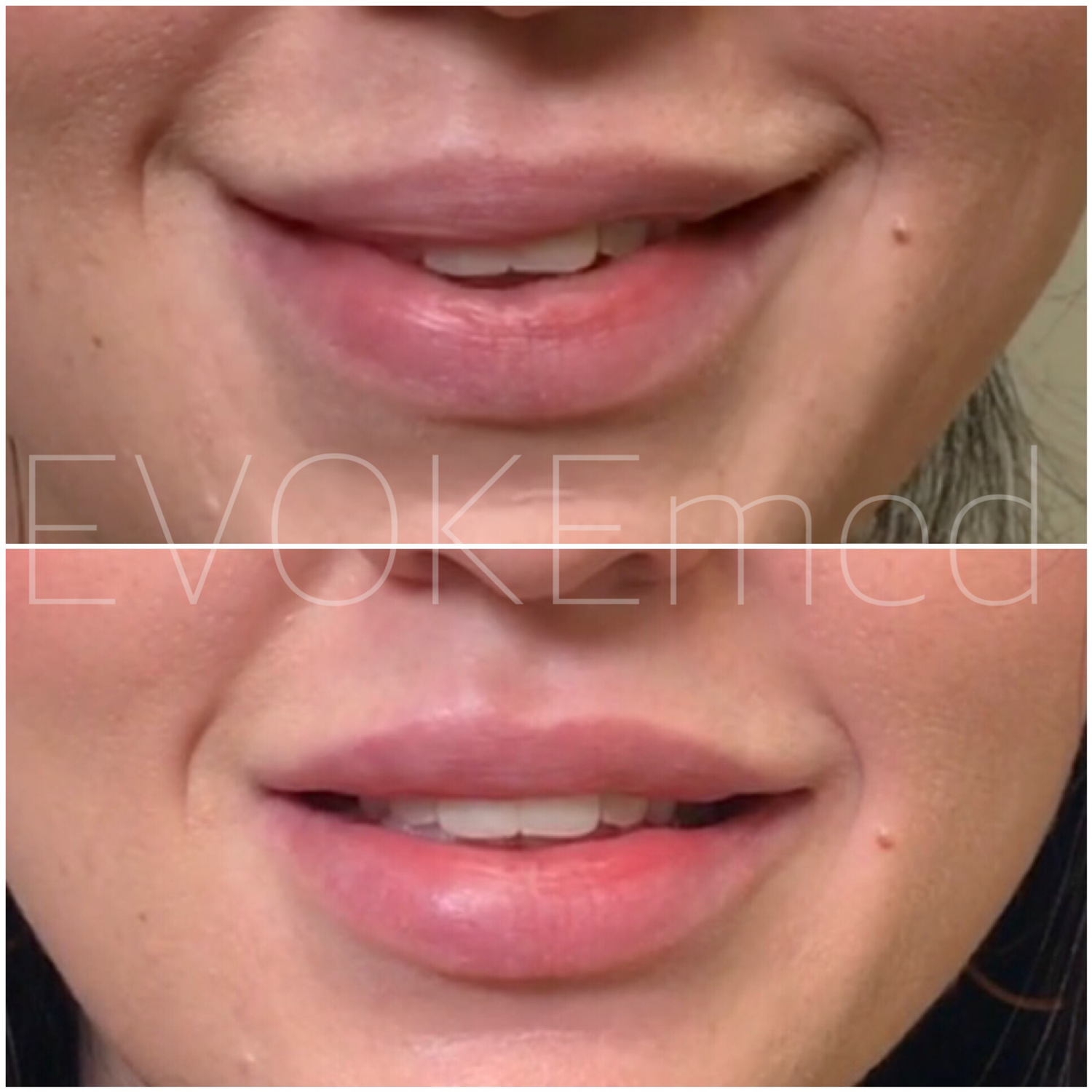 Botched Filler Corrections — EVOKE AESTHETICS