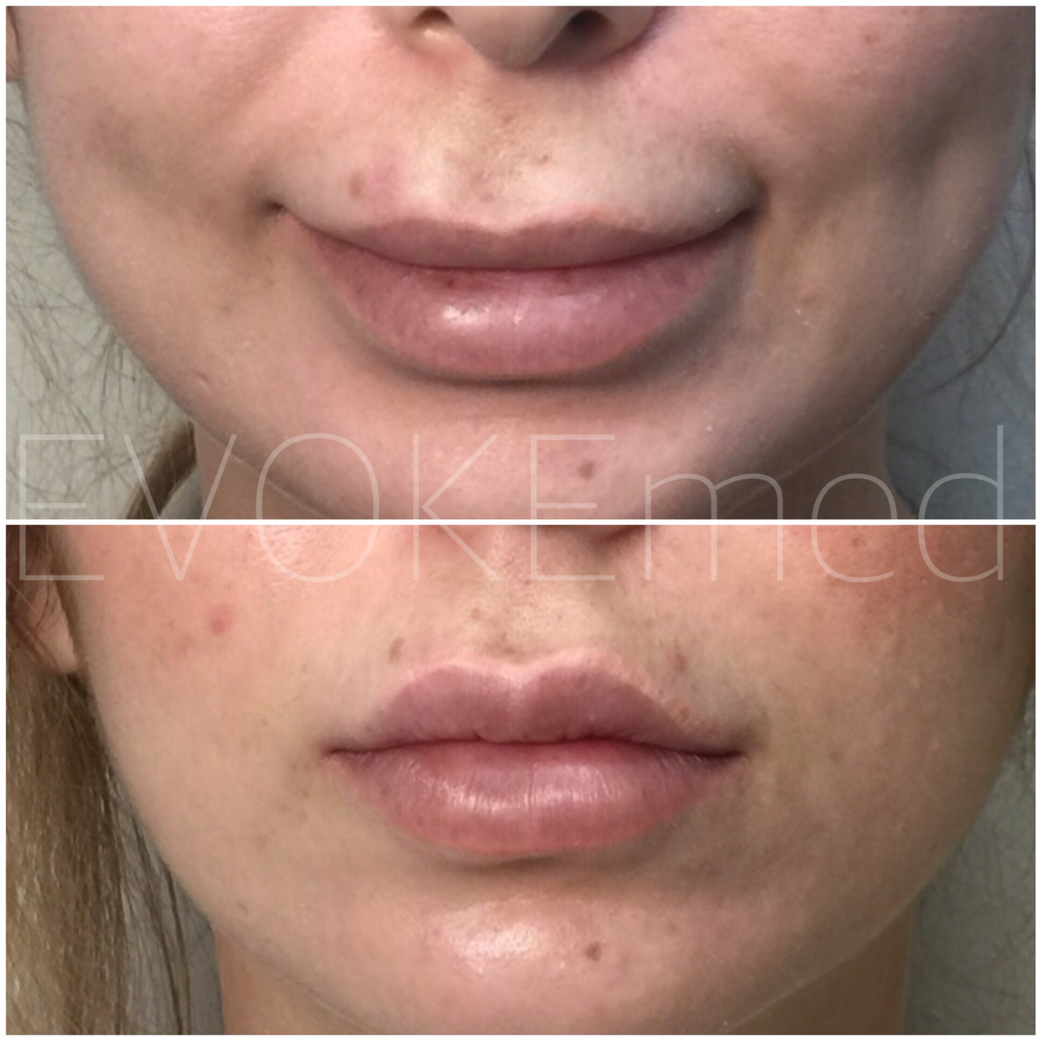 Botched Filler Corrections — EVOKE AESTHETICS