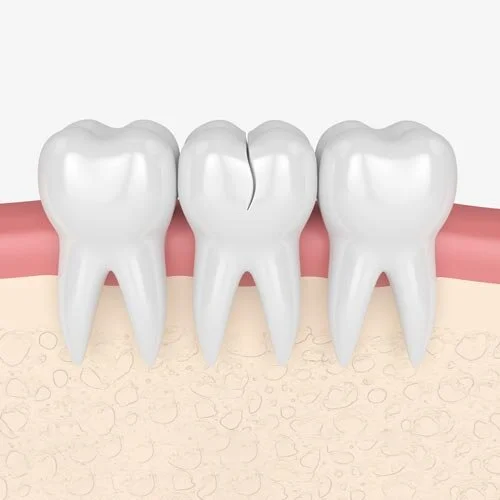 Chipped tooth – causes and treatment | Kowhai Dental — Whangarei ...
