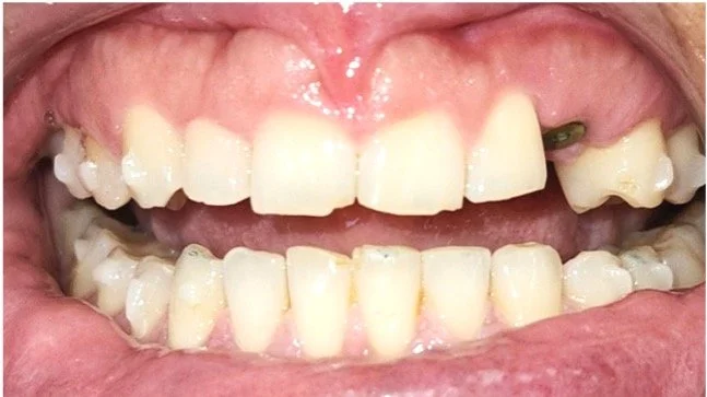 Transformative Smiles Gallery: Before and After Dental Results ...