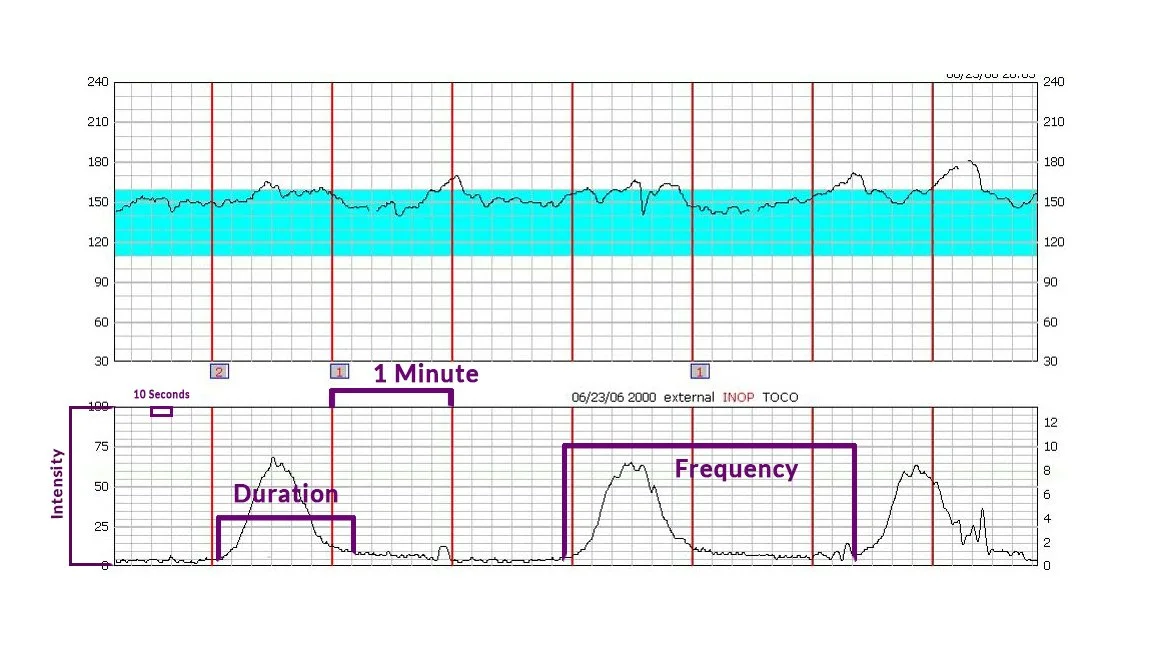 How to Read a Hospital Contraction Monitor for Labor and Delivery — Birth & Life Photography