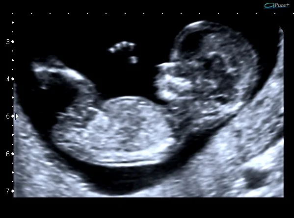 Pregnancy Scanning - Prices — The Ultrasound Centre