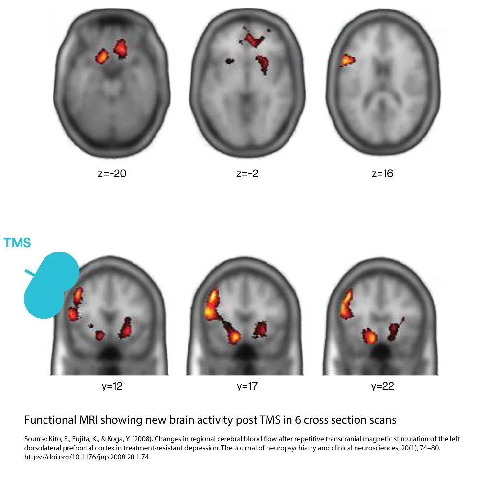 Transcranial Magnetic Stimulation (TMS) — Sweetgrass Psychiatry