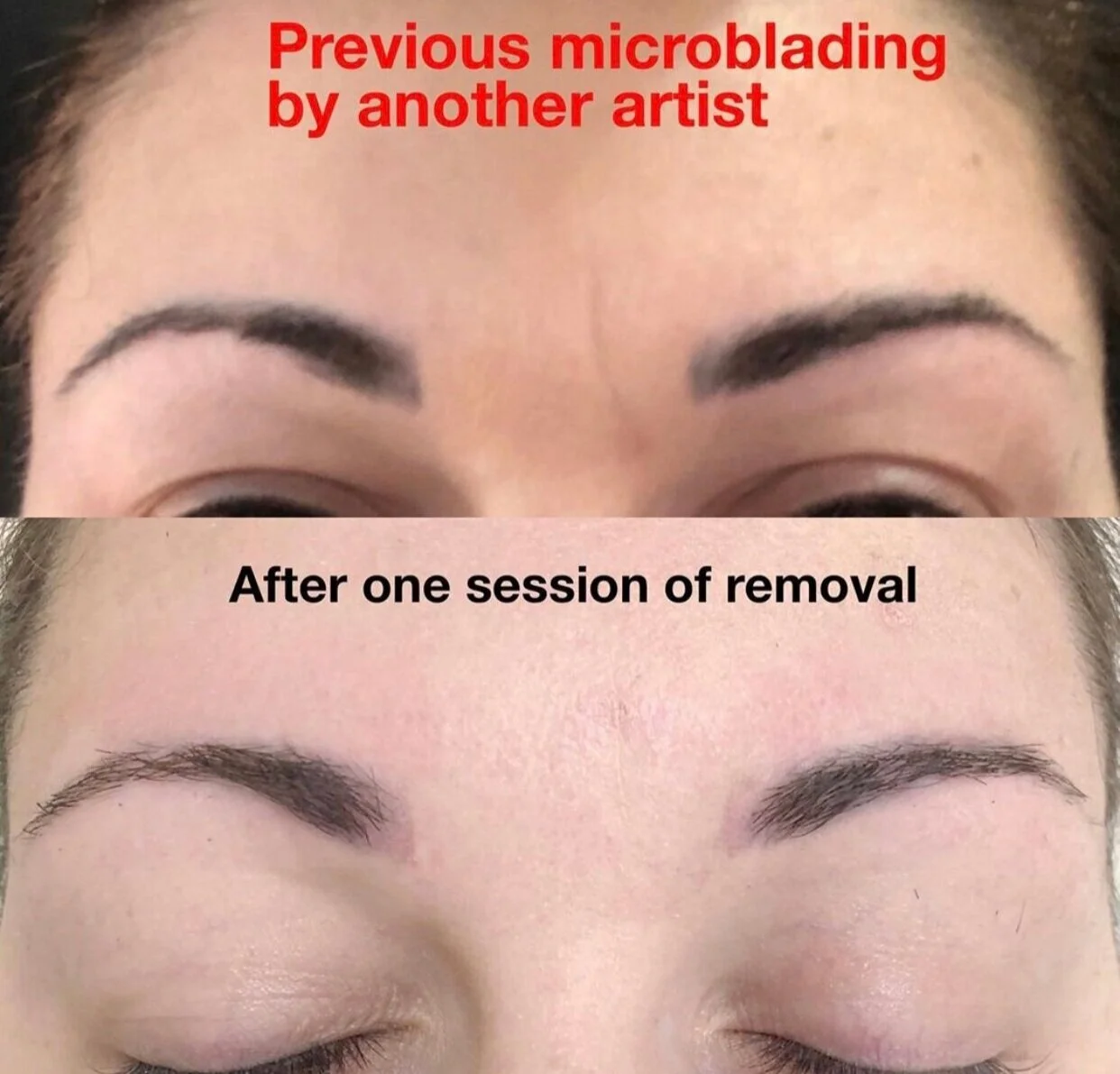 microblading removal, permanent makeup removal — Microblading By Angela ...