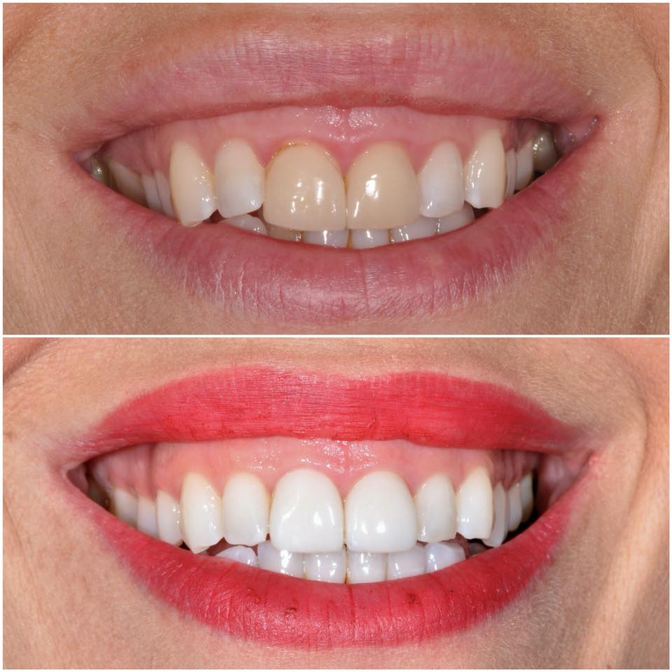 Invisalign Invisible Braces in Chelmsford | Dental Smiles Chelmsford ...