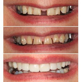 Invisalign Invisible Braces in Chelmsford | Dental Smiles Chelmsford ...