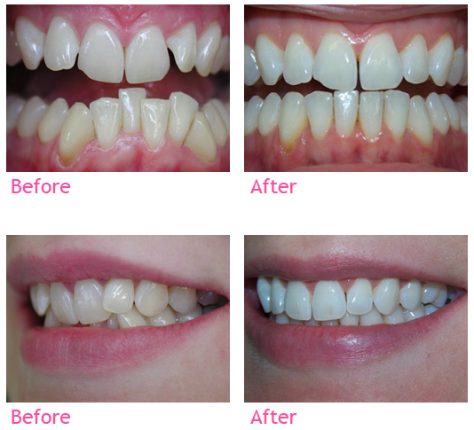 Invisalign Before And After Crowding