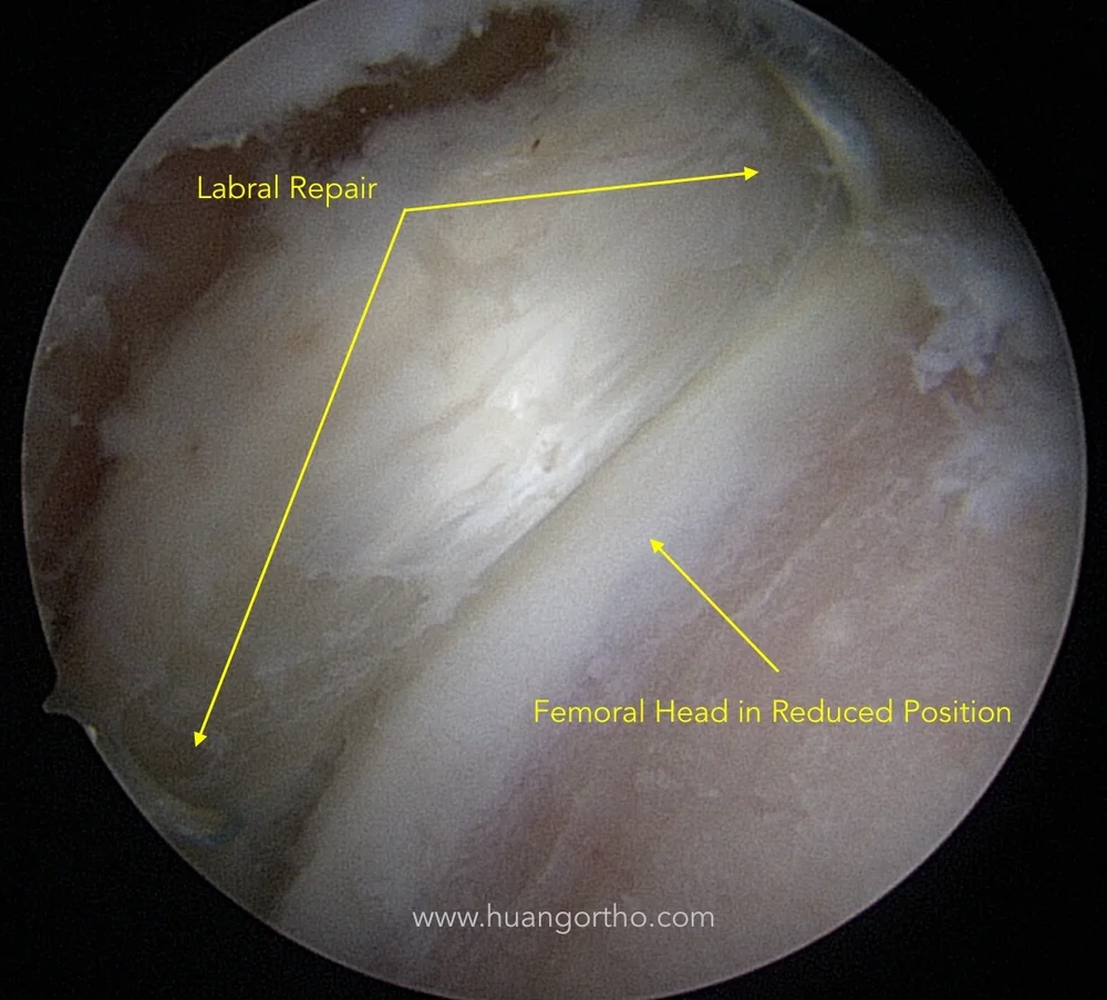 Hip Labral Tear, Cartilage Tear — Huang Orthopaedics