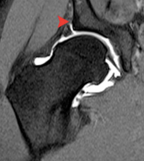 Hip Labral Tear, Cartilage Tear — Huang Orthopaedics