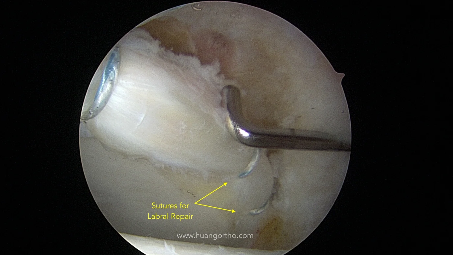 Hip Labral Repair & Reconstruction — Huang Orthopaedics