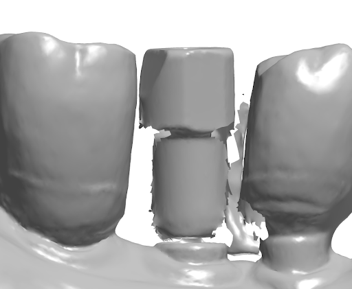 Avoid The Most Common Implant Scanning Mistakes — Paramount Dental Studio