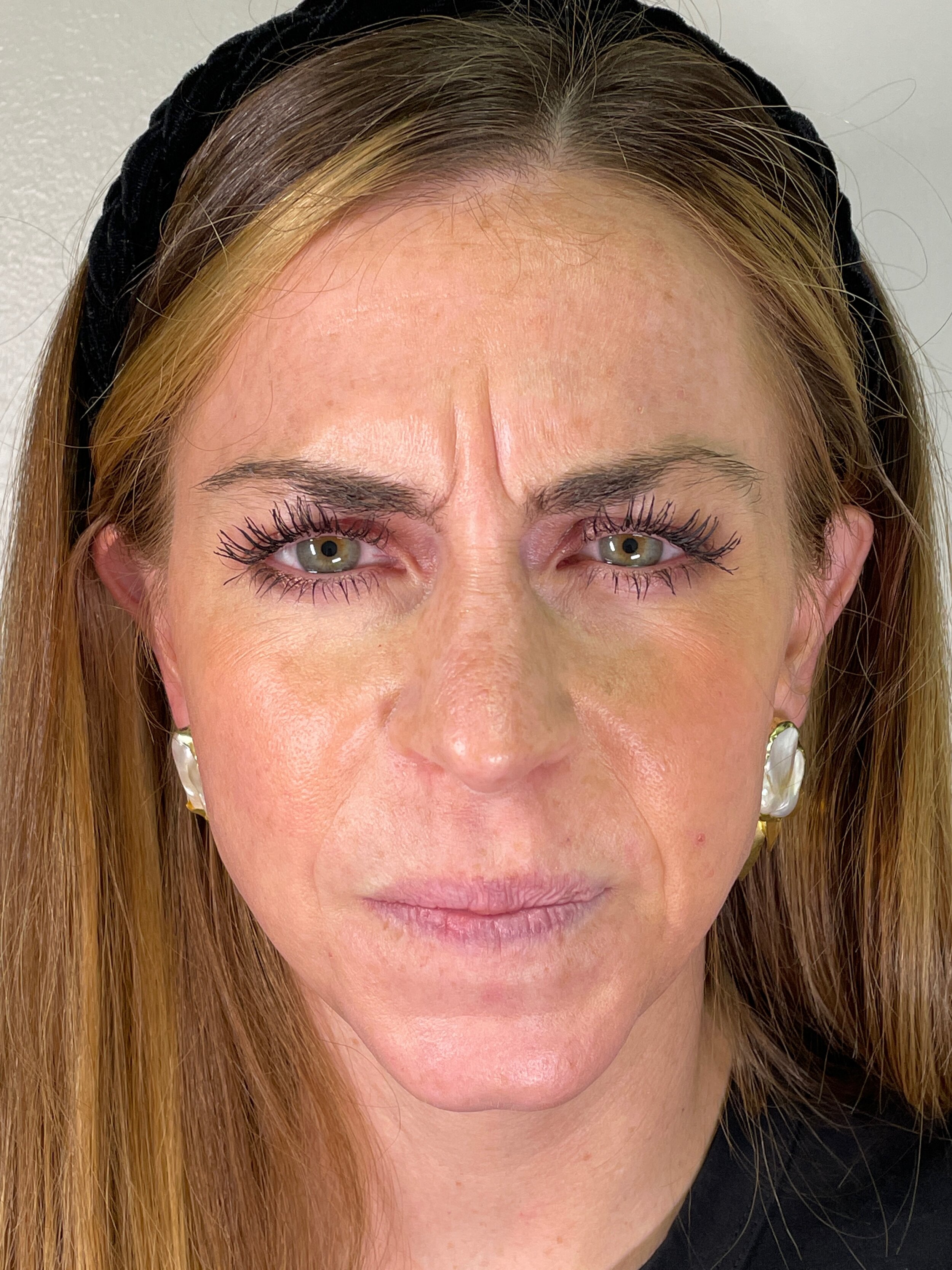 Botox Injection in Athens GA: Cosmetic Wrinkle Treatment — The Moore ...