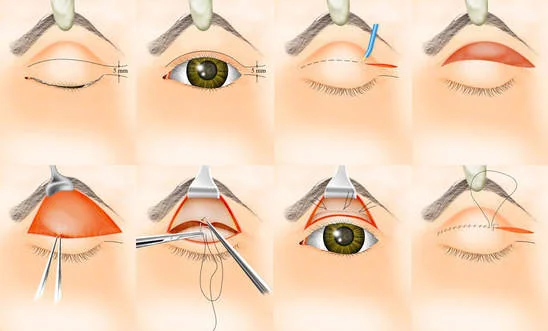 Congenital Ptosis — Patel Plastic Surgery, BCK Patel MD