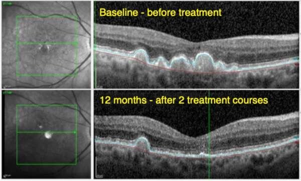Valeda Light Therapy — Retina Institute of the Carolinas & the Macular ...