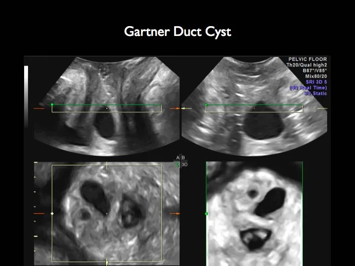 Gartners Duct Cyst Ultrasound