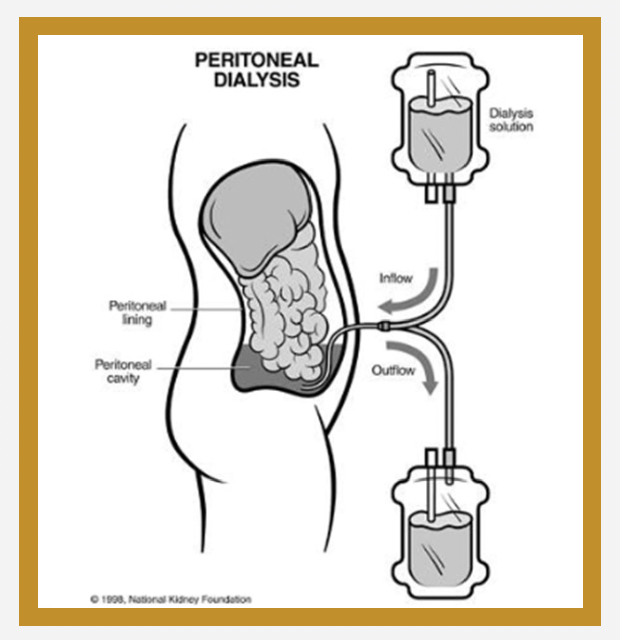 Chronic Kidney Disease Treatment Options (Peritoneal Dialysis) — InterMed Consultants
