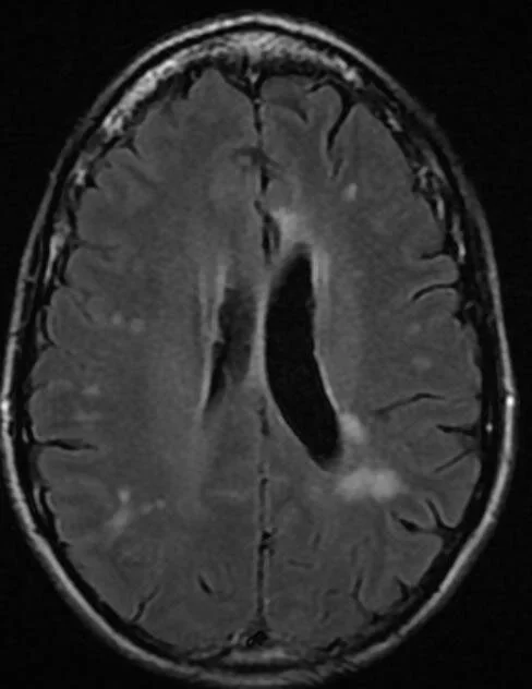 “Incidentalomas”: How Brain MRI Can Complicate Migraine Management ...