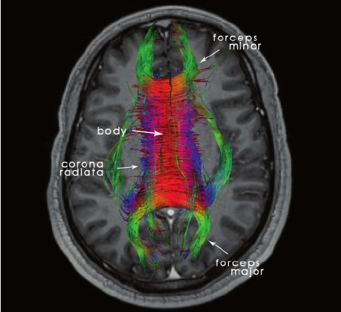 Corpus Callosum Imaging — Tom Gillette