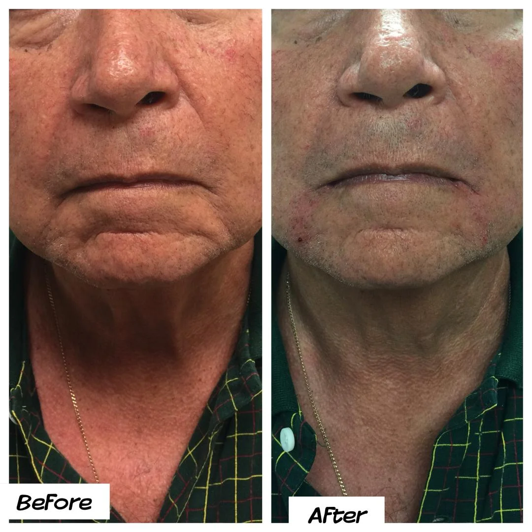 Wrinkle Reduction and Volume Correction — Boca Raton Skin Institute