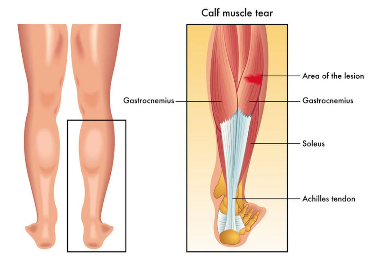Calf Muscle Injuries Brookvale Physio HPRS Physio